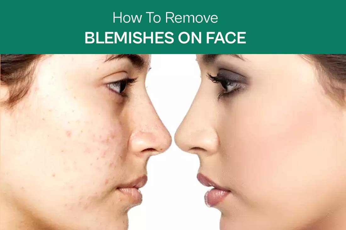 How to Remove Blemishes on Face | Best Tips for Clear Skin